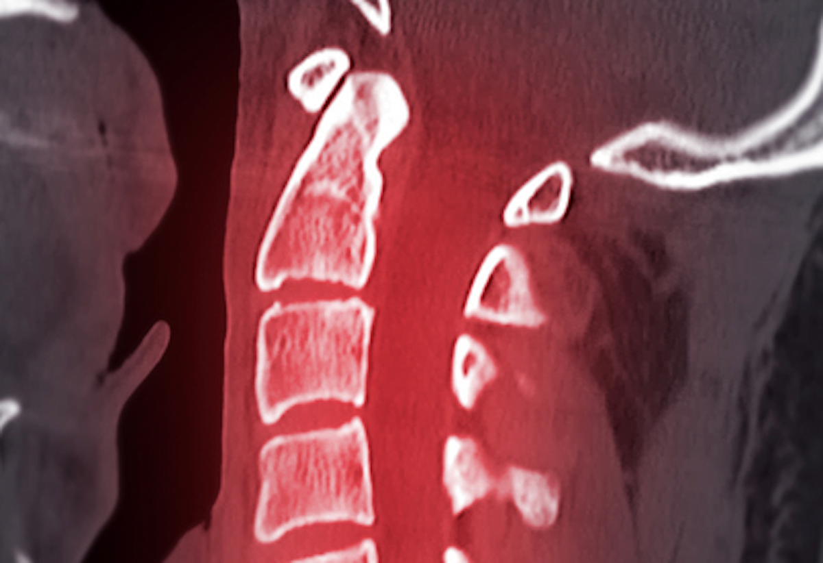 Profundizando en la Inestabilidad cráneo-cervical